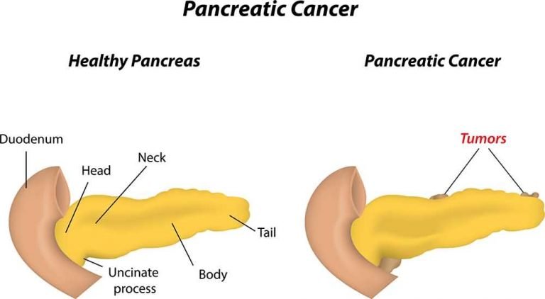 Pancreatic Cancer Symptoms; 12 Warning Signs of Pancreatic Cancer