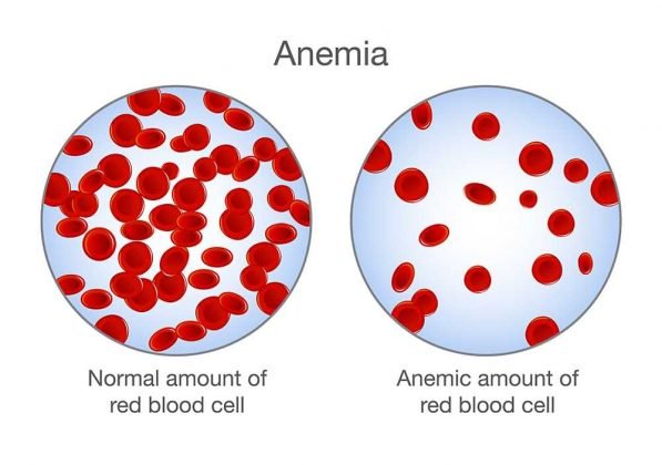 Anemia; 13 Warning Signs & Symptoms of Anemia - Left Side Pains