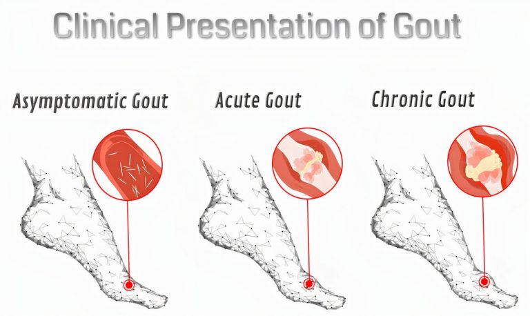 Gout | Causes, Clinical features, Diagnosis & Treatment - Page 3 of 10 ...