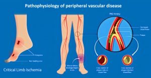 Peripheral Vascular Disease (PVD) | Causes, Symptoms, Diagnosis ...