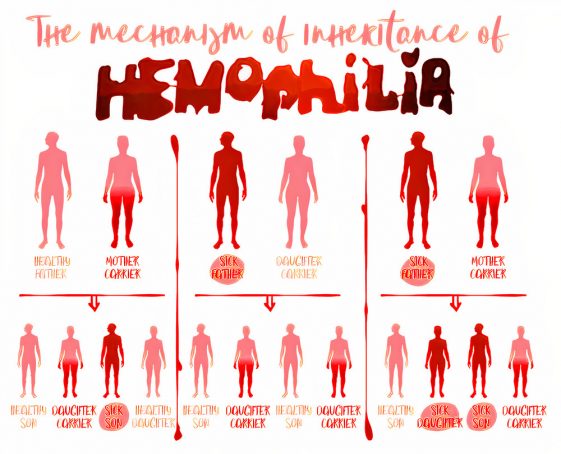 Hemophilia | All You Need to Know About Hemophilia - Page 9 of 16 ...