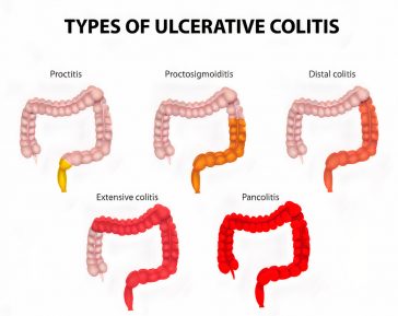 Ulcerative Colitis (UC): Causes, Symptoms, Types, Diagnosis & Treatment ...
