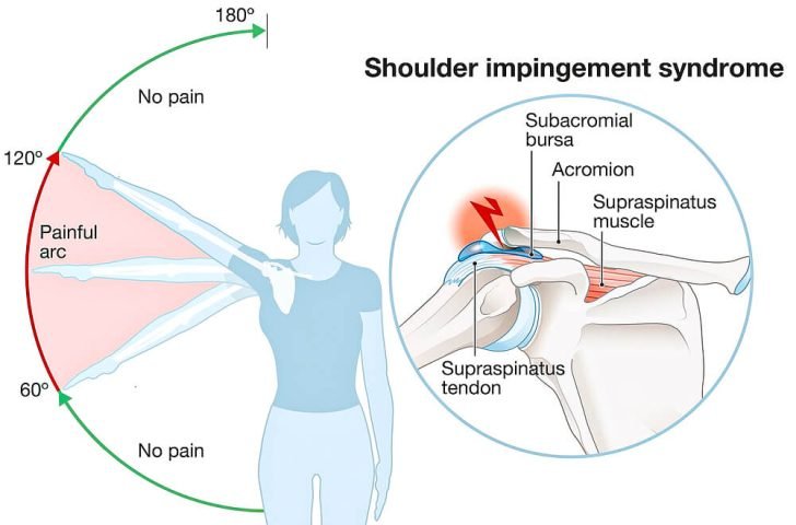 Shoulder Pain When Lifting The Arm | Causes & Treatment Options - Left ...